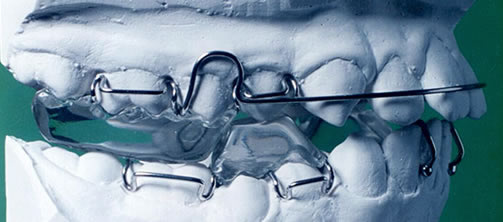 Functional Appliances - Available Treatments - Riverhouse Orthodontic ...