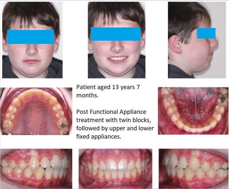 Can Orthodontic Functional Appliances Really Make the Lower Jaw Grow ...