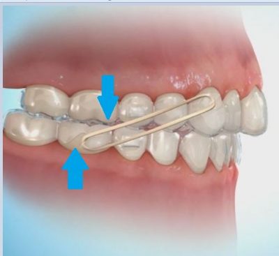 Will I have to wear elastics with invisalign? - Clonmel Orthodontics