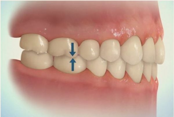 Will I have to wear elastics with invisalign? - Clonmel Orthodontics