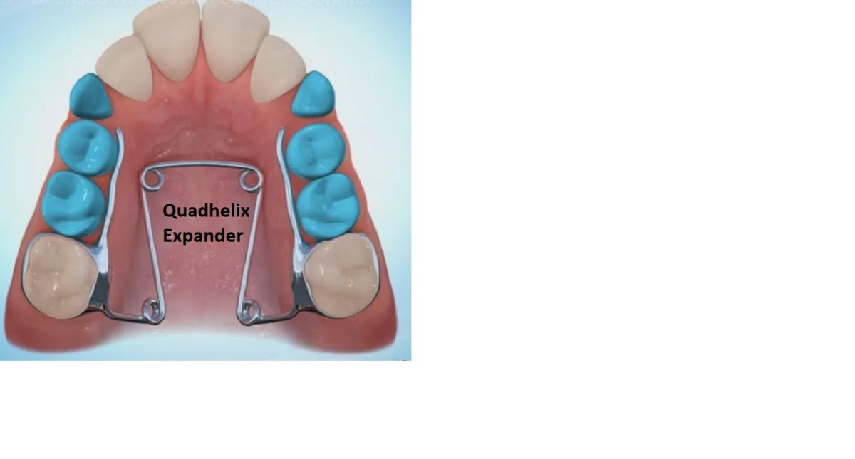 Correction of Cross-Bites / Use of Expanders - Clonmel Orthodontics