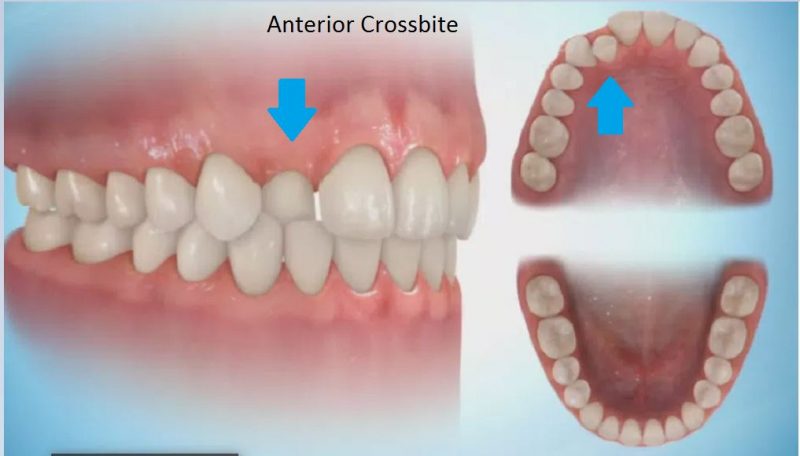 Correction of Cross-Bites / Use of Expanders - Clonmel Orthodontics