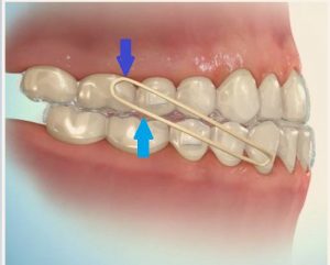 Will I have to wear elastics with invisalign?