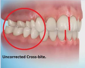 Correction of Cross- Bites / Use of Expanders