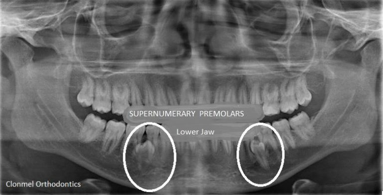 What are supernumerary teeth? - Clonmel Orthodontics