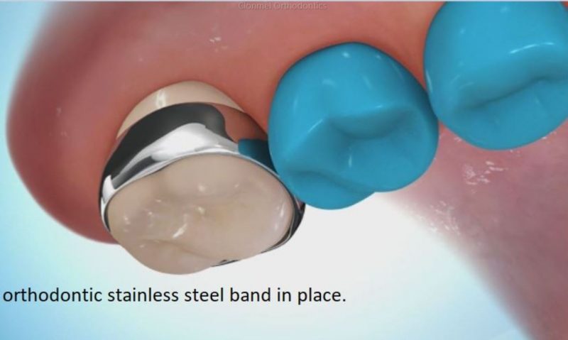 What are Orthodontic Separators / Spacers? - Clonmel Orthodontics