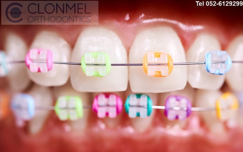 What are Coloured Braces? - Clonmel Orthodontics