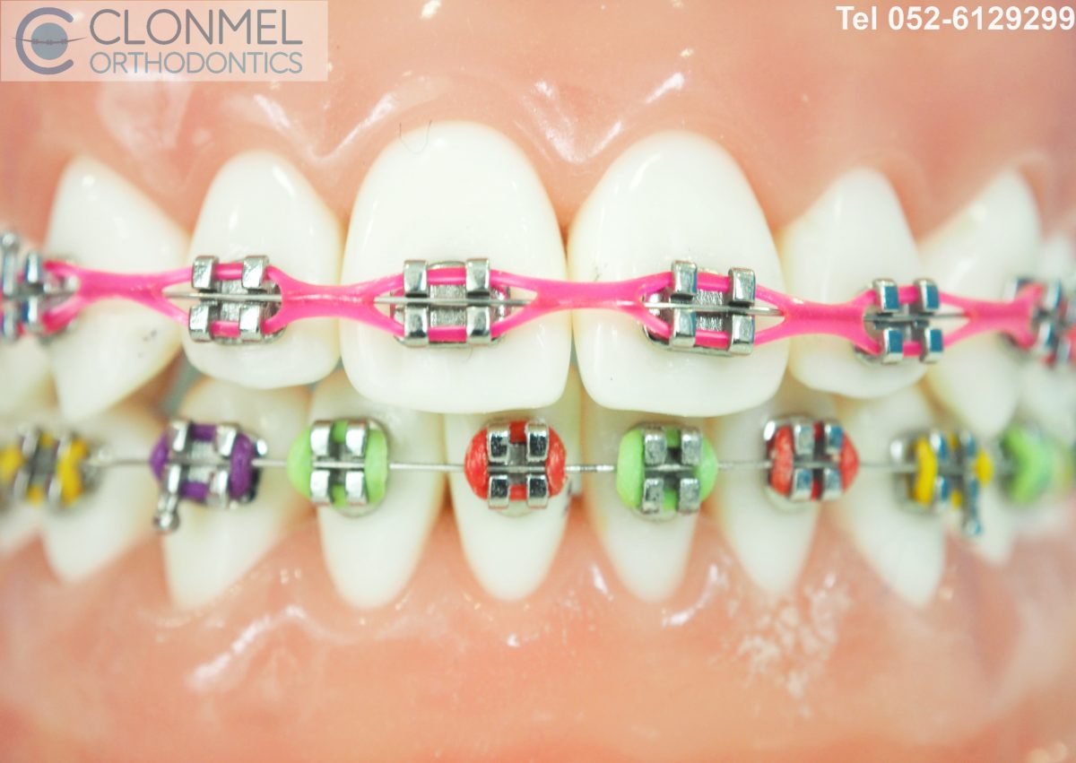 What are Coloured Braces? - Clonmel Orthodontics
