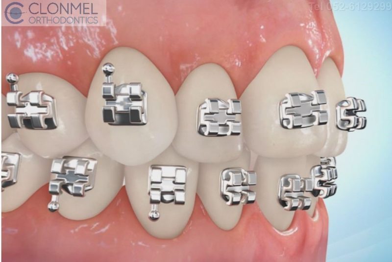 What are Coloured Braces? - Clonmel Orthodontics