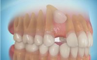 Ectopic Canines - Clonmel Orthodontics