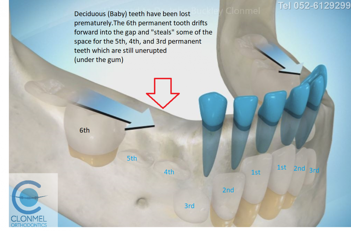 What is dental (orthodontic) crowding? - Clonmel Orthodontics