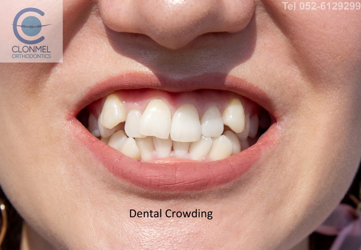 What is dental (orthodontic) crowding? - Clonmel Orthodontics
