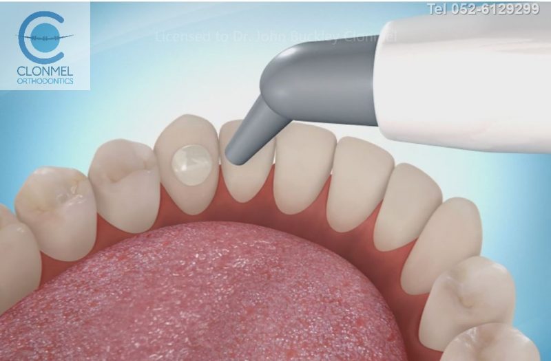 What are bonded (fixed) orthodontic retainers? - Clonmel Orthodontics