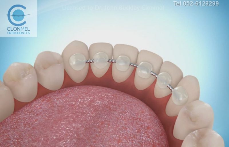 What are bonded (fixed) orthodontic retainers? - Clonmel Orthodontics