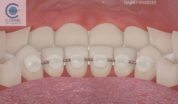What are bonded (fixed) orthodontic retainers? - Clonmel Orthodontics