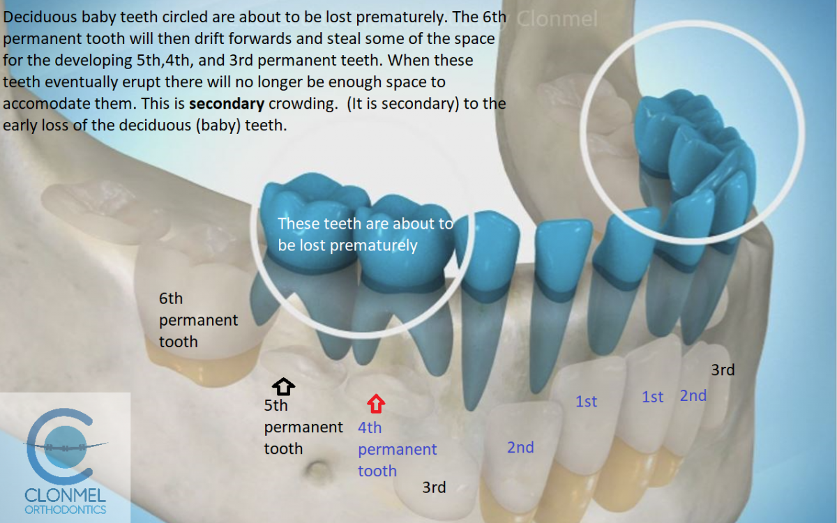 What is dental (orthodontic) crowding? - Clonmel Orthodontics