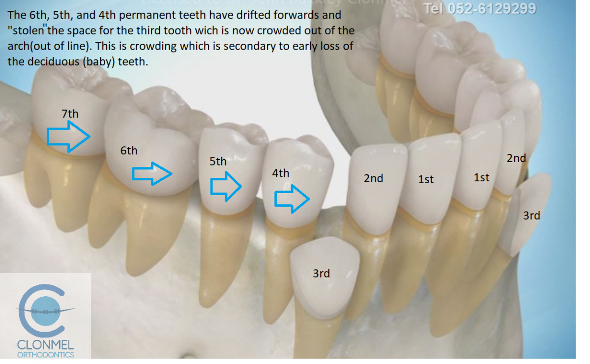 What is dental (orthodontic) crowding? - Clonmel Orthodontics