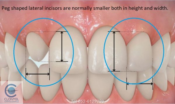 What are peg shaped lateral incisors? - Clonmel Orthodontics
