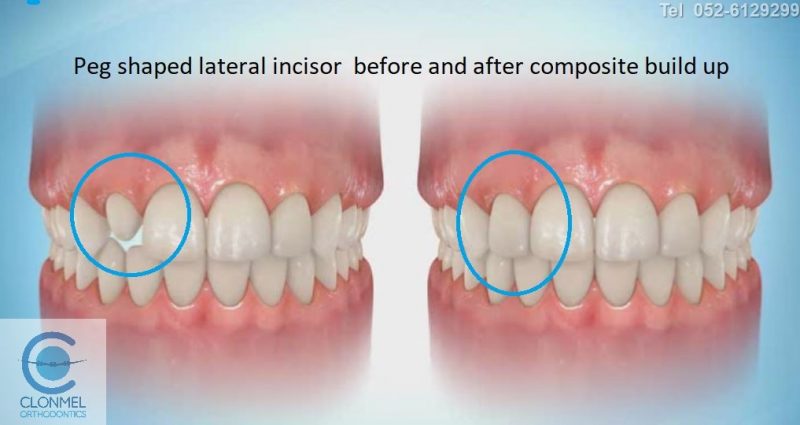 What are peg shaped lateral incisors? - Clonmel Orthodontics