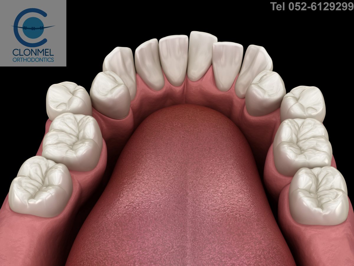 What is dental (orthodontic) crowding? - Clonmel Orthodontics