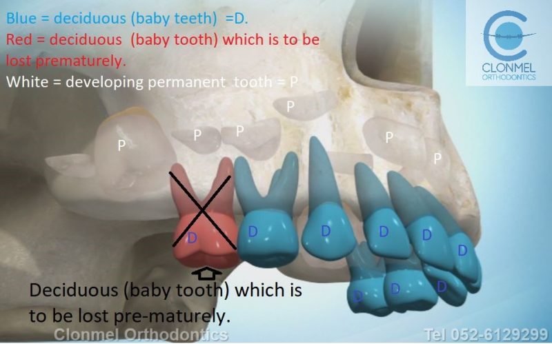 Why do we try to avoid losing baby teeth prematurely? - Clonmel ...