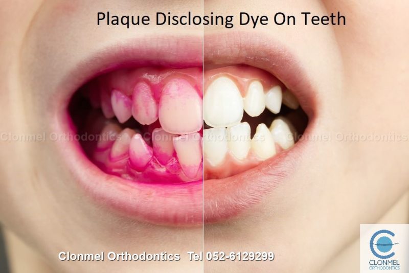 Plaque disclosing tablets in Orthodontic treatment. - Clonmel Orthodontics