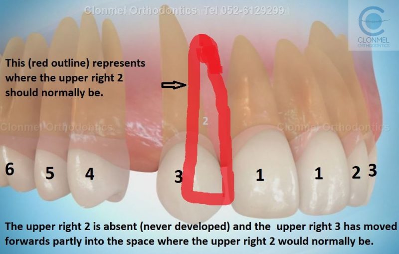 Missing Lateral Incisors Part 1. - Clonmel Orthodontics