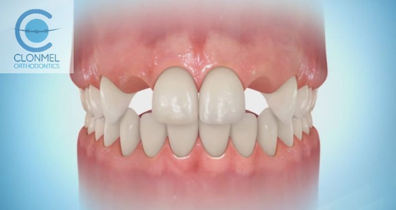 Missing Lateral Incisors Part 1. - Clonmel Orthodontics