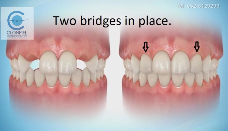 Missing Lateral Incisors Part 2. "The re-opening the space option ...