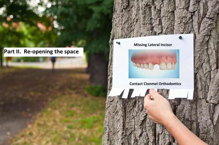 Missing Lateral Incisors Part 2. "The re-opening the space option ...