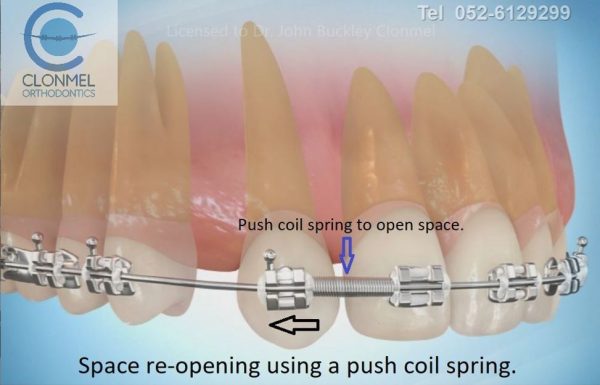 Missing Lateral Incisors Part 2. "The re-opening the space option ...