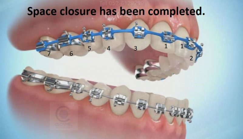 Missing Lateral Incisors Part 3. The "closing the space" option, with ...