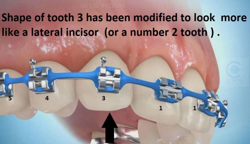 Missing Lateral Incisors Part 3. The "closing the space" option, with ...
